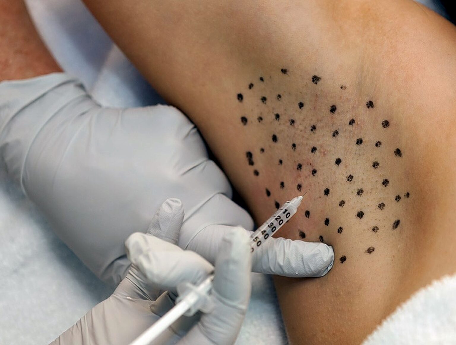 Botox treatment of increased axillary hyperhydrosis